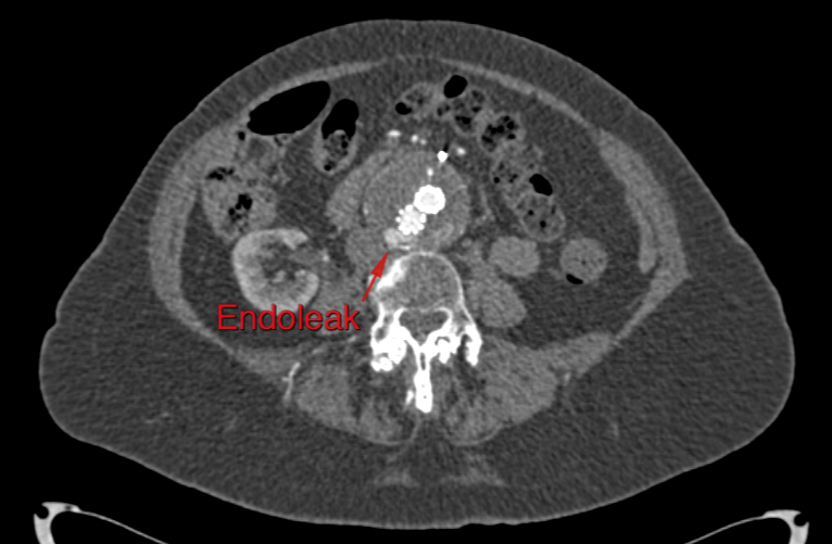 Tratamento percutâneo de endoleak tipo II guiado por DynaCT – Dr ...